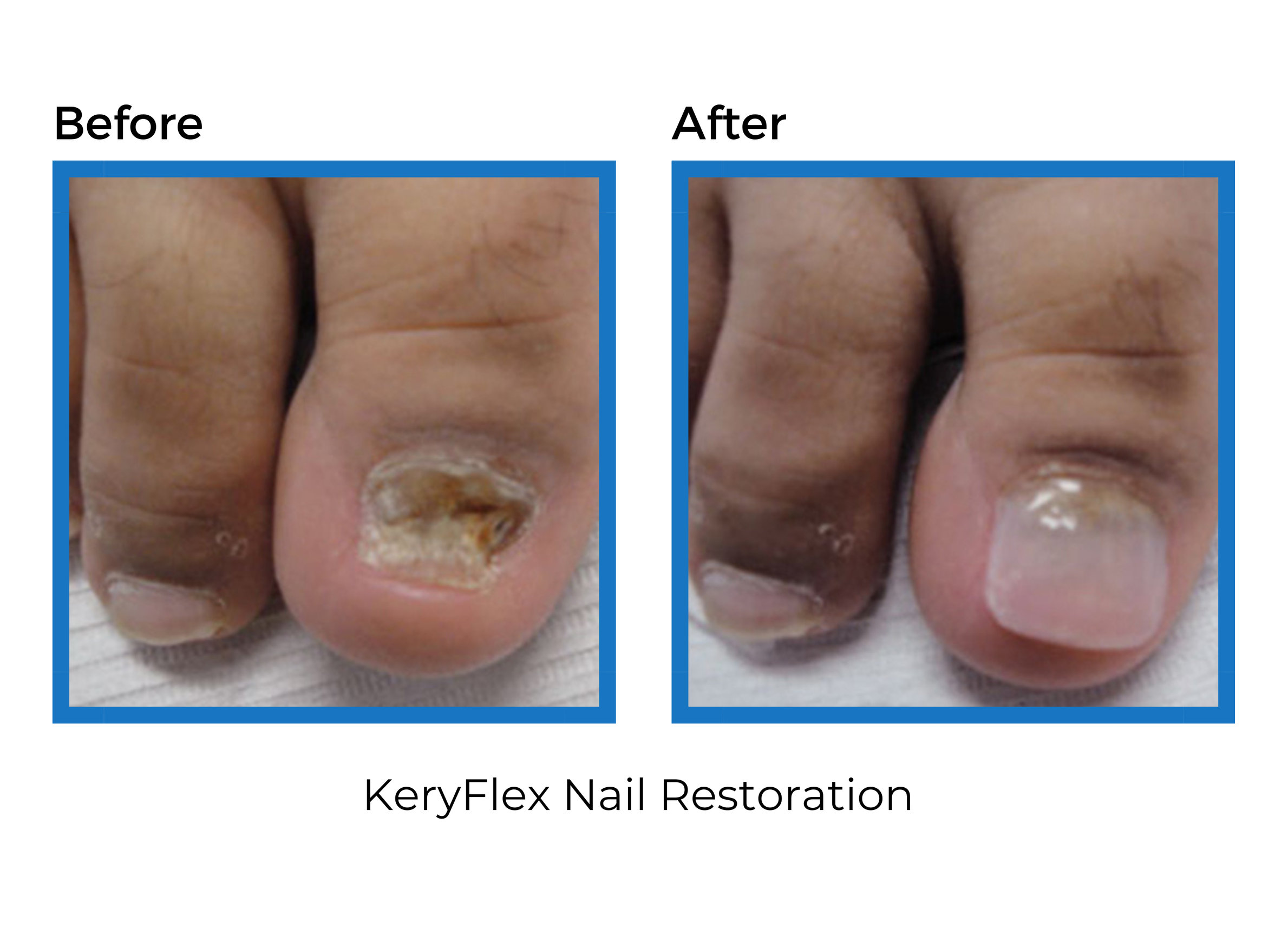 KeryFlex™ Nail Restoration System - Foot & Ankle Centers of Frisco and ...